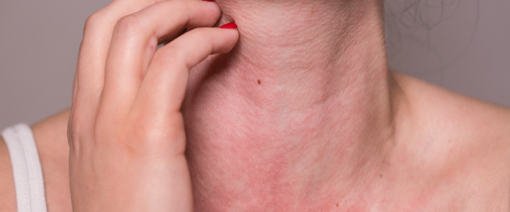 Identifier et traiter une allergie au soleil : symptômes